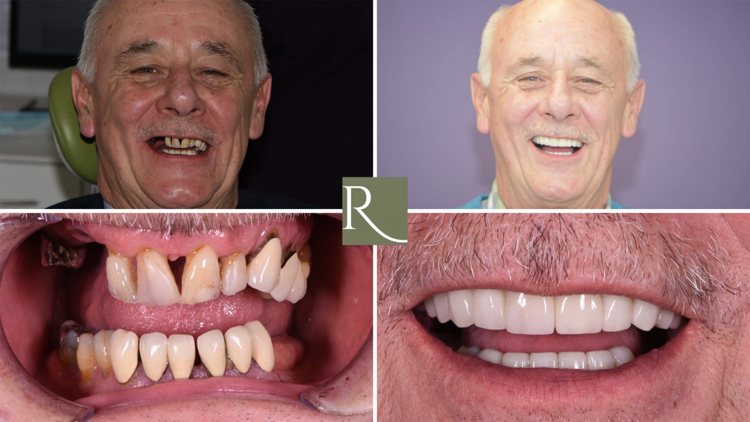 Arthur's Dental Implants Transformation | Robinson's Dental Practice