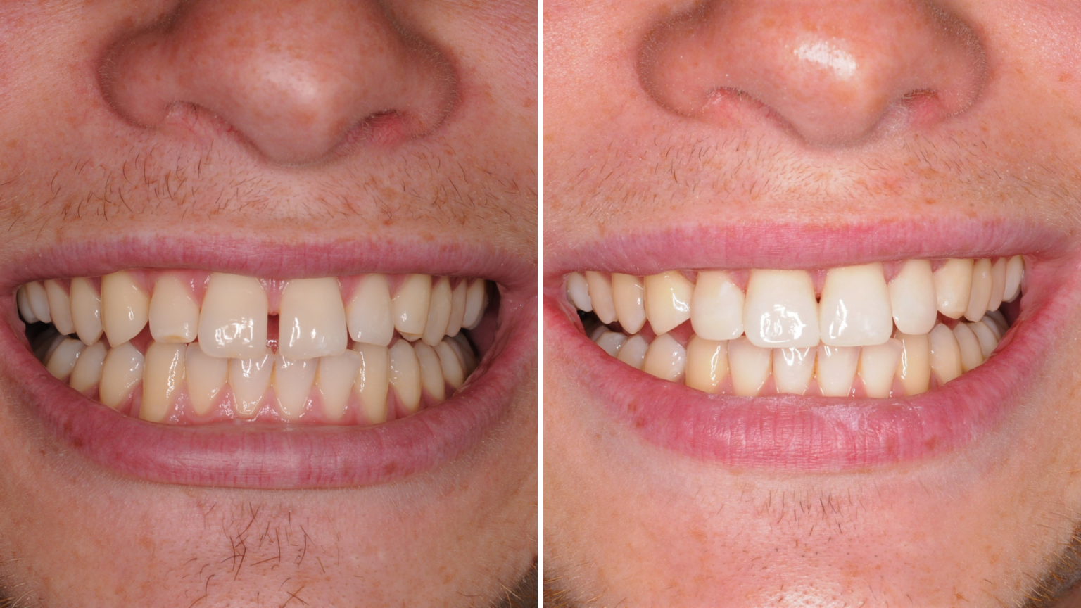 James Composite Bonding Transformation