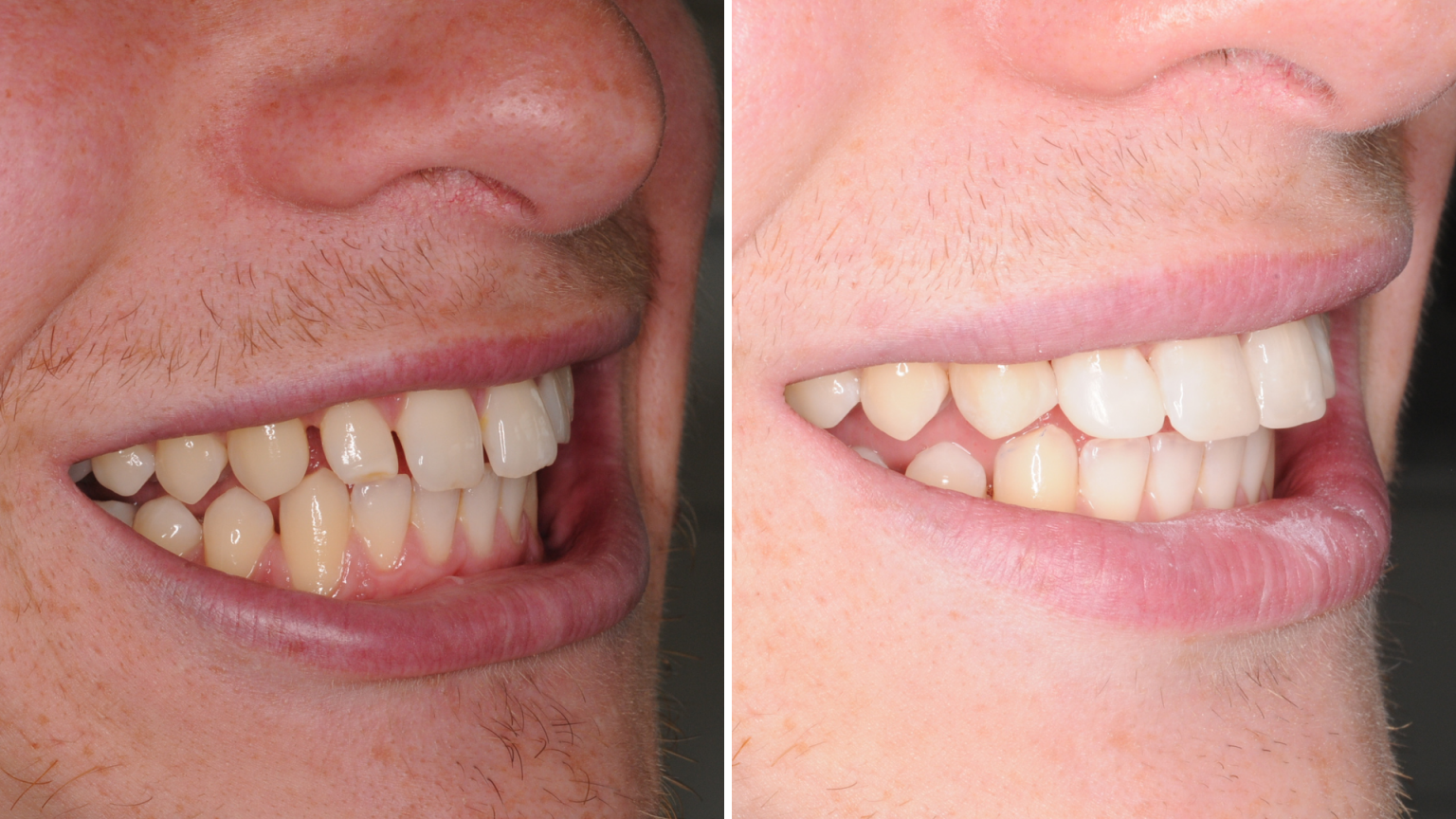 James Composite Bonding Transformation