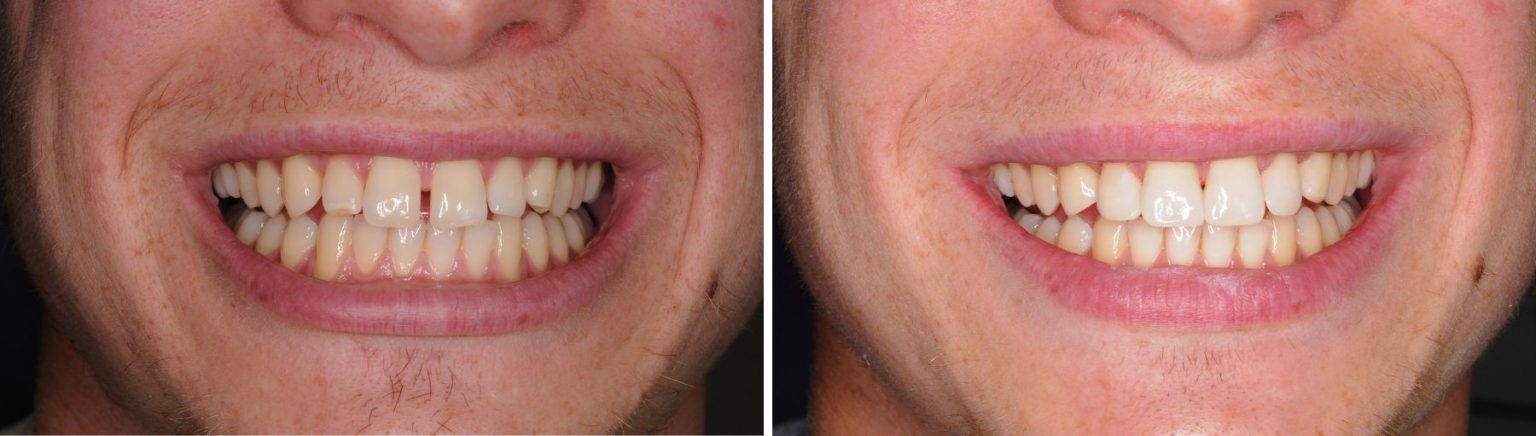Your Complete Guide To Composite Bonding | Robinson's Dental Practice